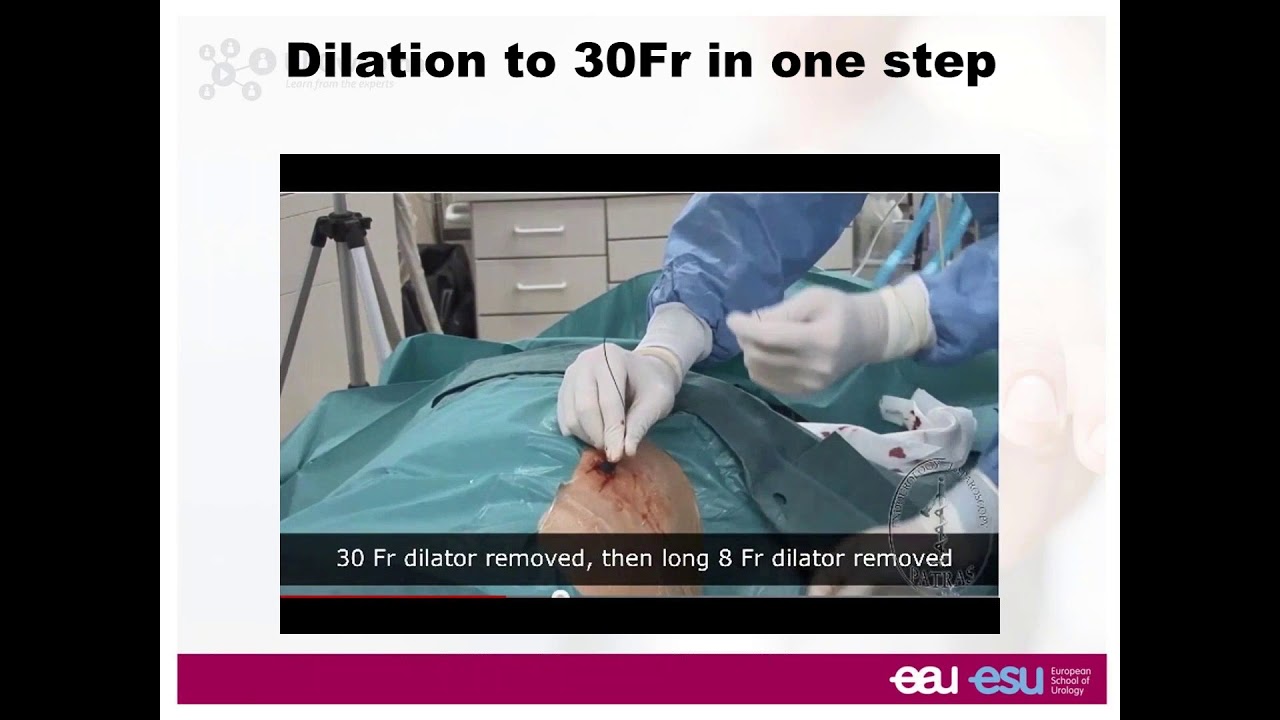 Urowebinar: PCNL approaches: Prone - YouTube