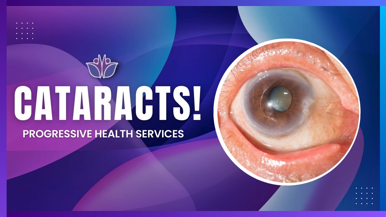 Understanding Cataracts Causes Symptoms And Treatment Options