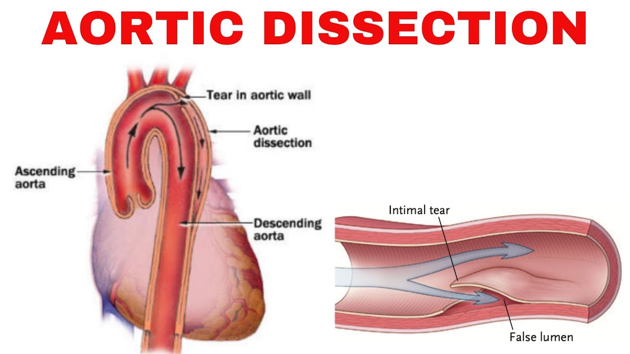 Aortic Dissection - YouTube
