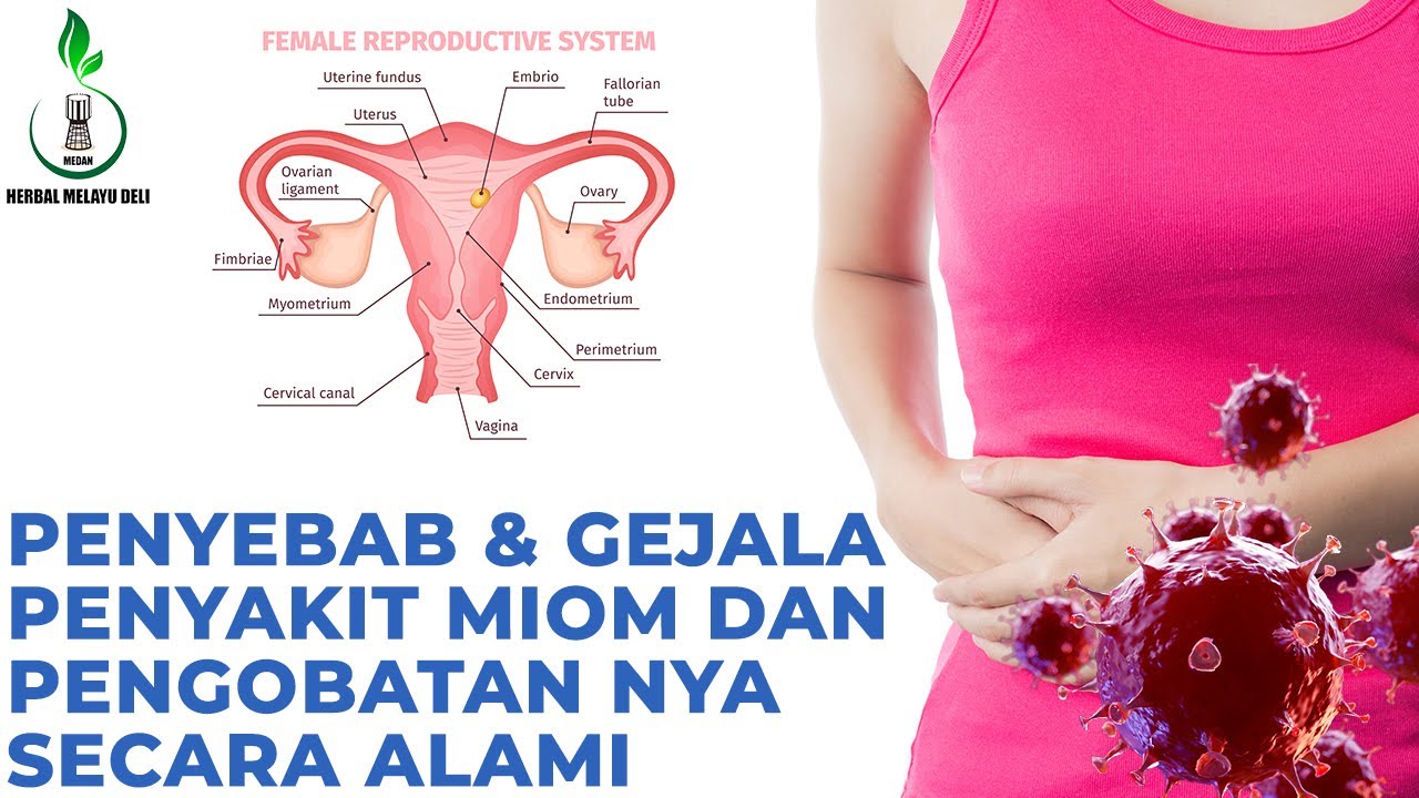 Penyakit Miom; Penyebab, Gejala & Metode Pengobatan Secara Alami - YouTube