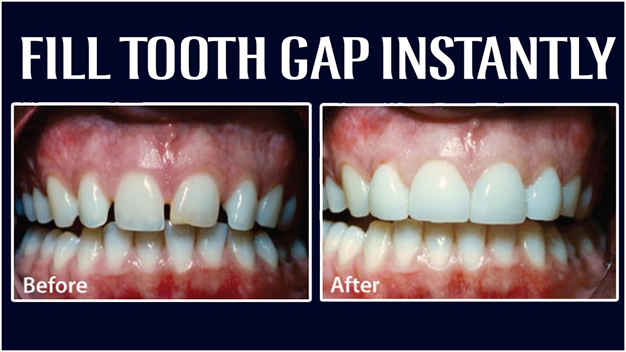 How to Instantly Fill Tooth Gap? || Dr.Vijayalakshmi about Tooth Gap ...
