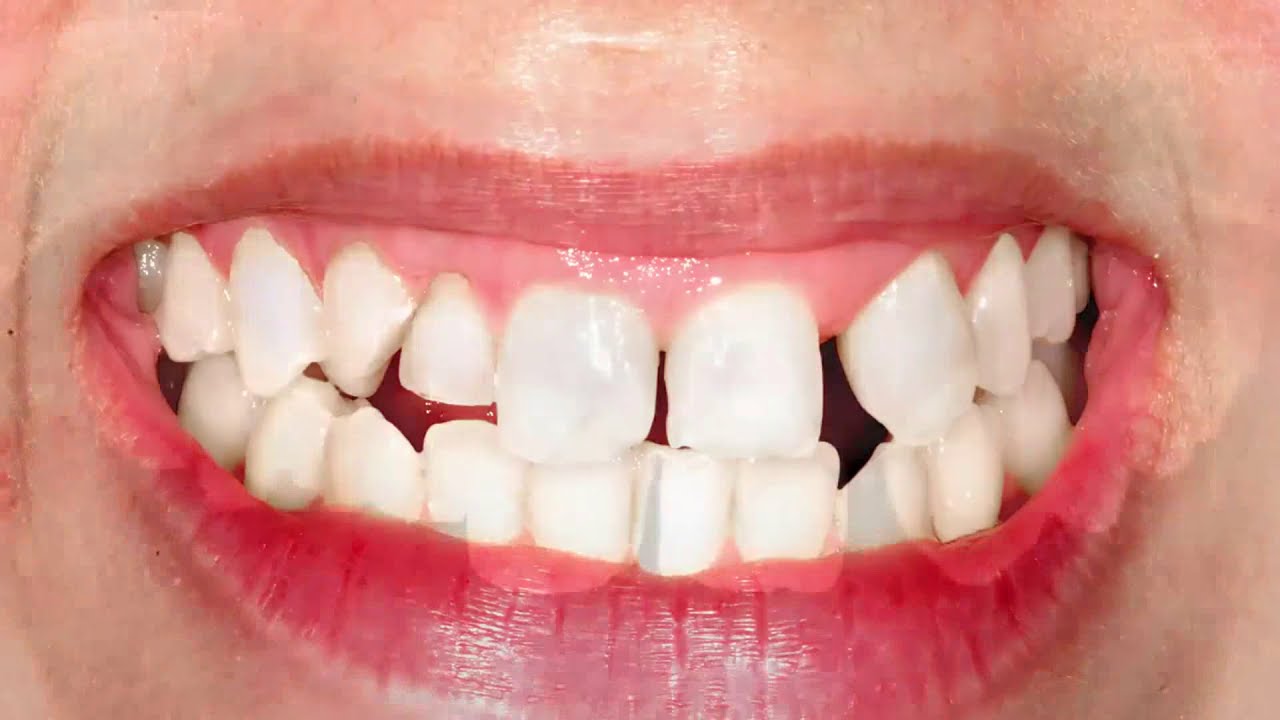 Structur 2 Voco Dental Speed Graph - YouTube