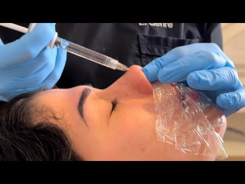 HO FATTO IL FILLER ALLE LABBRA E RHINOFILLER A TORINO ️🇮🇹 Condivido la ...