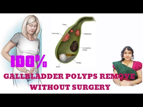 #Gallbladder polyps #100% #Gallbladder polyps remove without surgery # ...