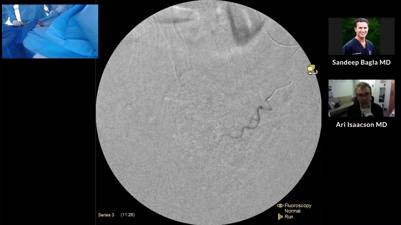 PAE: Live Radial Prostatic Artery Embolization with Dr. Bagla - YouTube