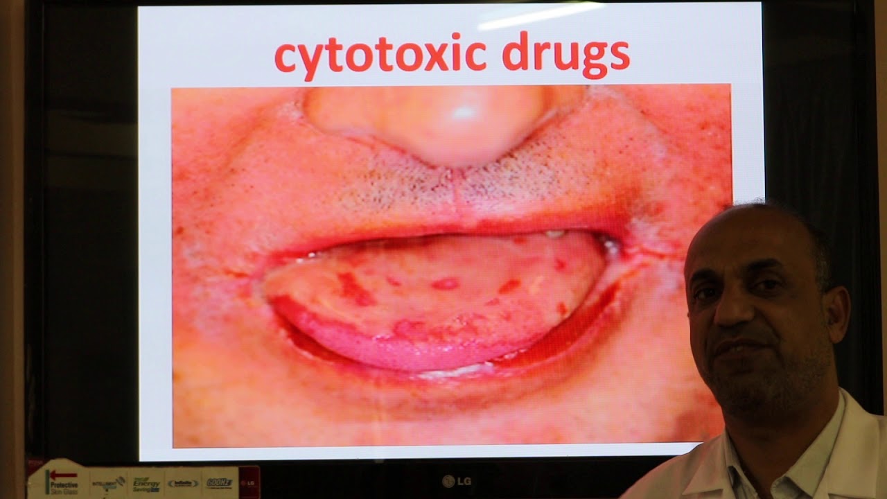 Mouth Ulcer, Dandruff and Seborrhoeic Dermatitis. By Dr. Dheyaa Jabbar ...