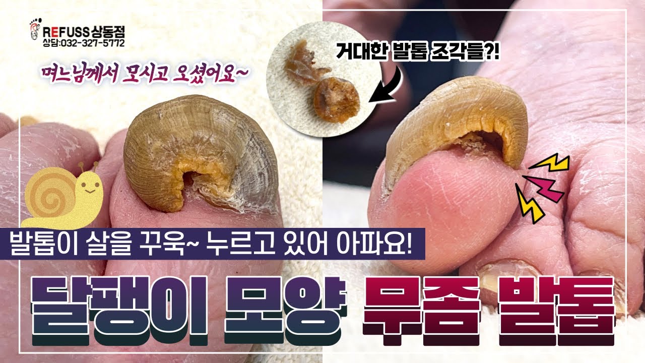 며느님께서 모시고 오신 🐌달팽이 모양🐌 무좀발톱 고객님 조갑구만증 스케일링 / Snail-Shaped Athlete's Foot ...