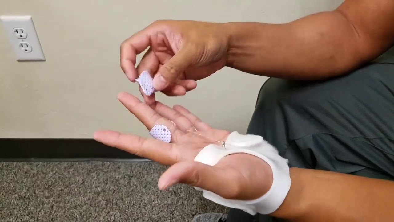Static Progressive Composite Finger Flextion Orthosis - YouTube