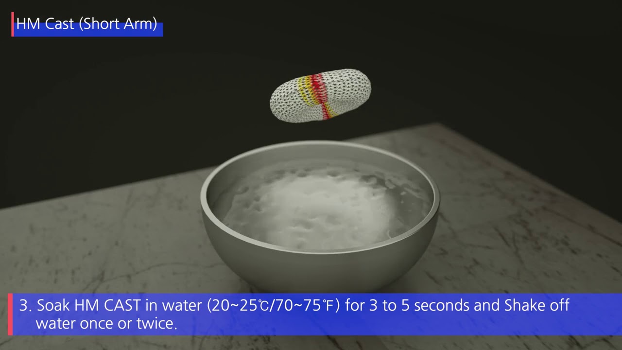 HM CAST Short Arm 3D Procedure - YouTube