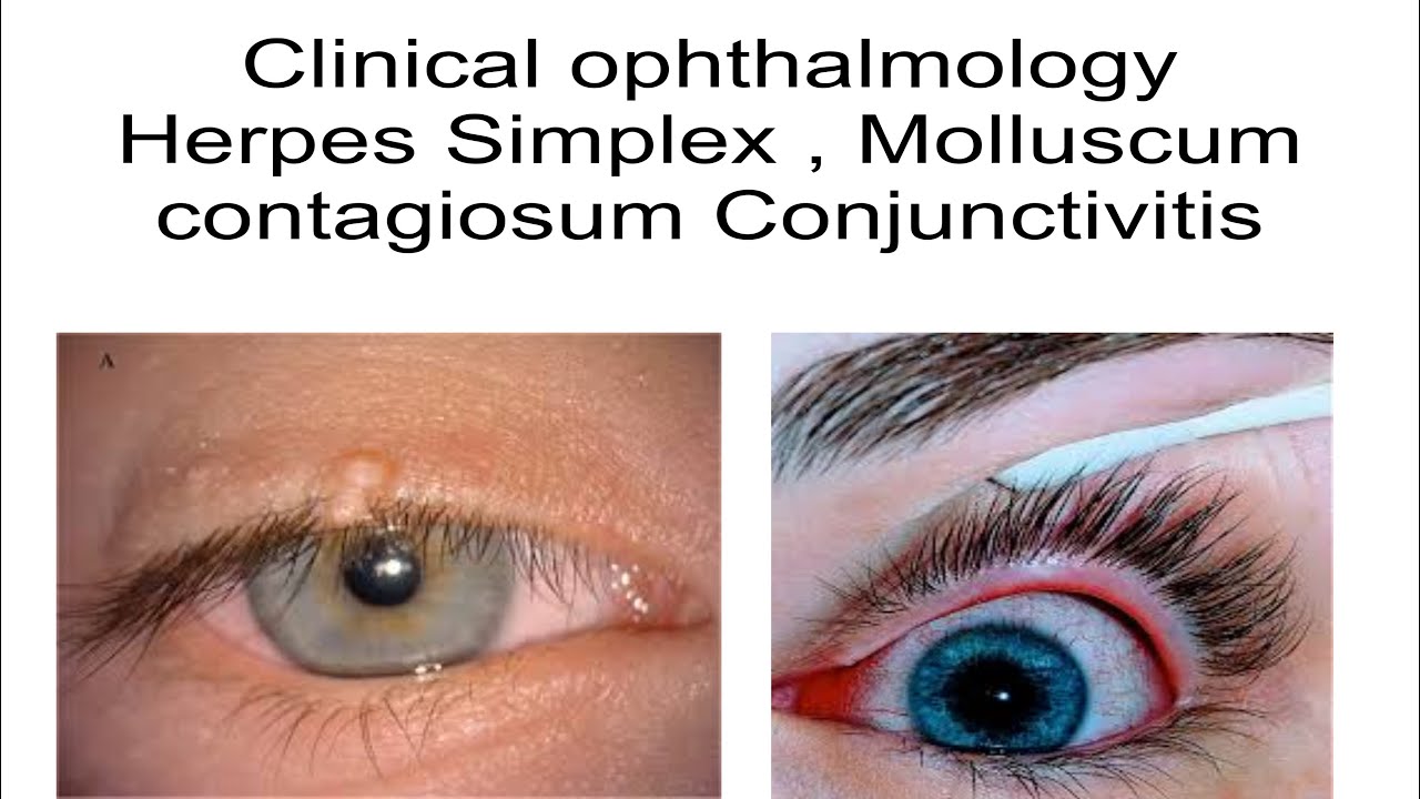 Clinical ophthalmology Viral Conjunctivitis in easiest way - YouTube