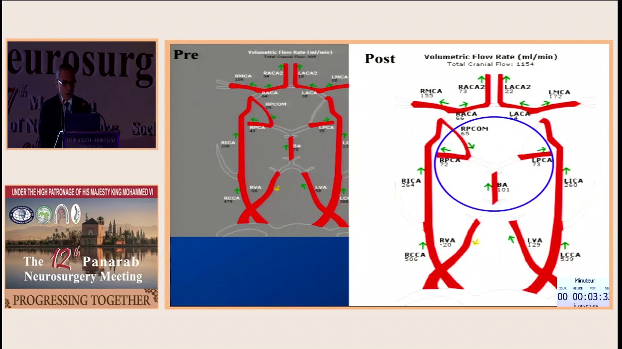 SMNC/PANS 2018- Prof Fady Charbel - Vertebrobasilar Disease - YouTube