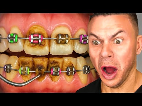 Watching Braces NIGHTMARES So You Don’t Have To