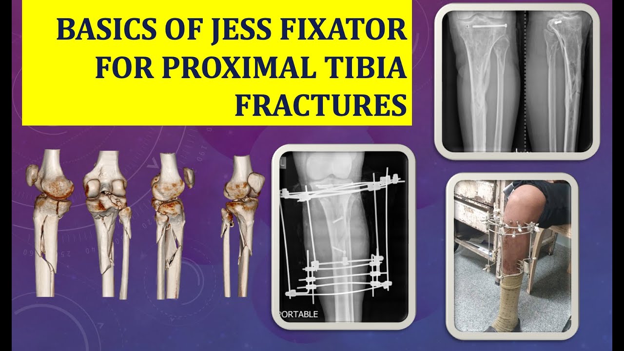 JESS Fixator Technique Basics for Proximal Tibia Fractures (Helmet ...