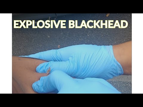 Explosive Old Blackhead | Pimple Popping - YouTube