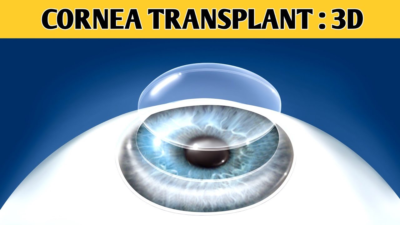 "Unlocking Vision: The Complete Guide to Cornea Transplant Surgery ...