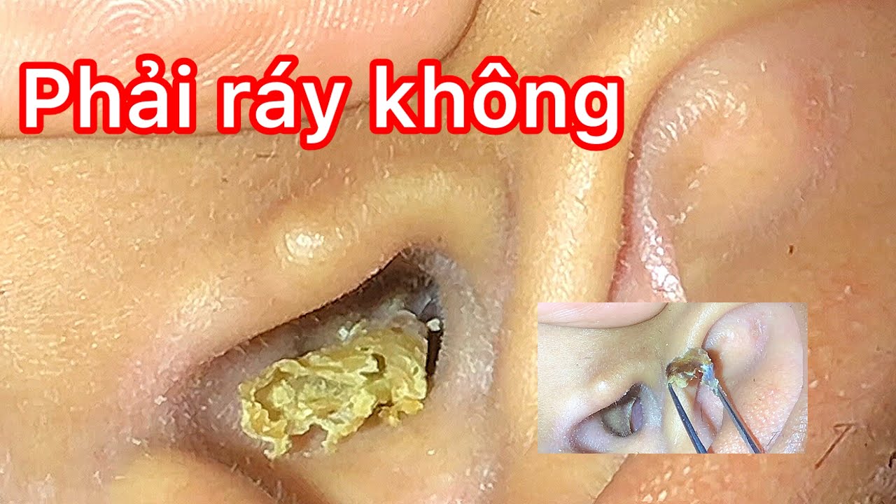 Lấy ráy tai, earwax #asmr #earcleaningasmr . Phần 120, Y MEN HAIR LS ...