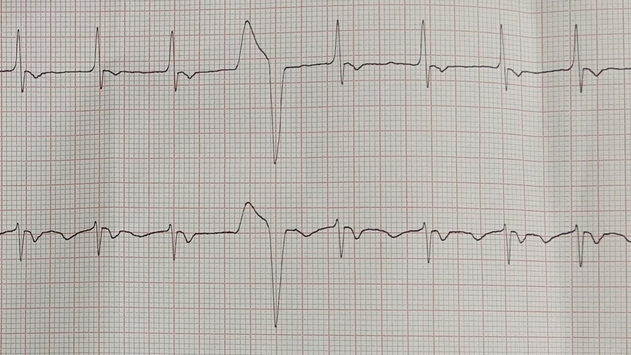 Intraventricular Conduction Delay & BUNDLE BRANCH BLOCKS - YouTube