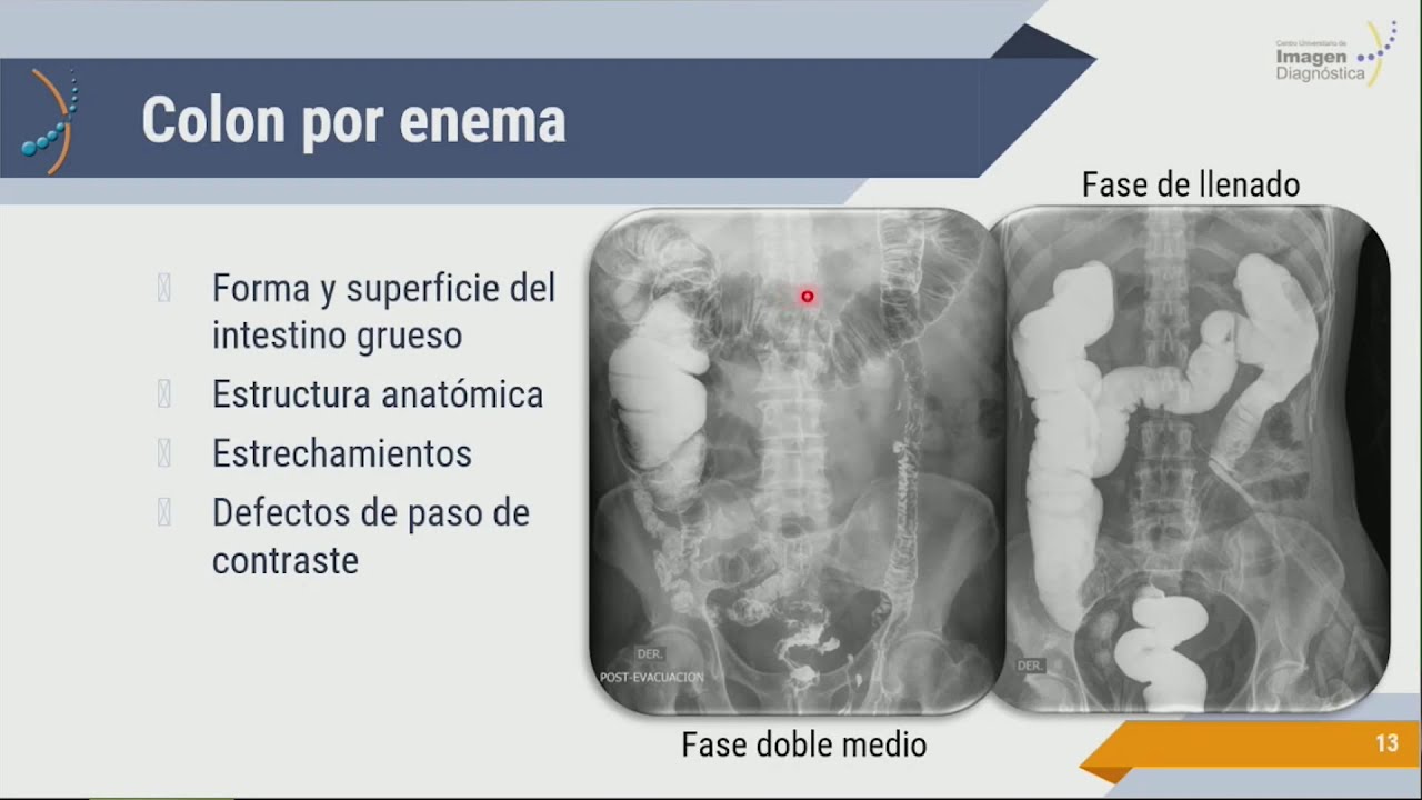 Radiología de Abdomen: Estudios Contrastados - YouTube