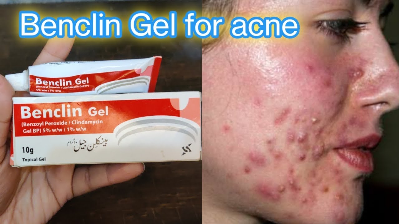 Benclin gel for acne ,pimples, Comedones , blackheads & whiteheads ...