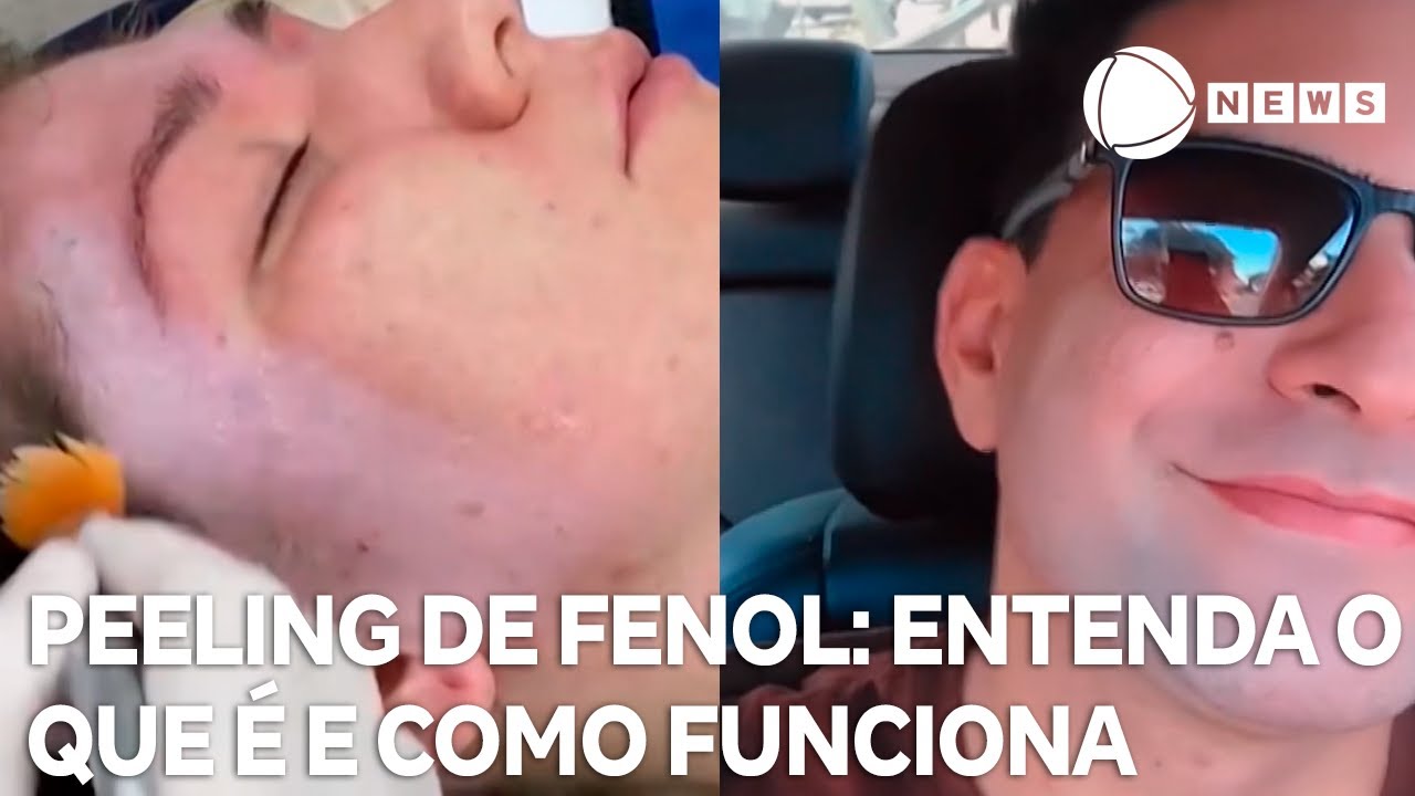 Peeling de fenol: entenda o procedimento feito por homem que morreu em ...