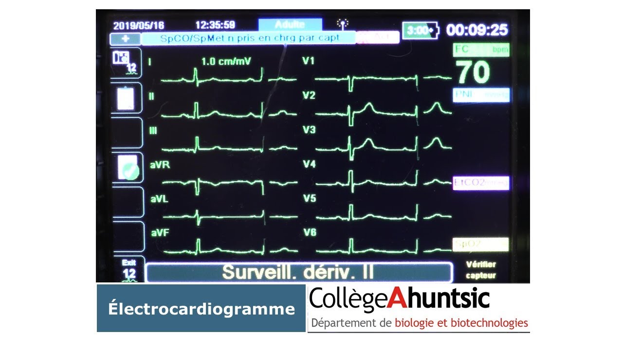 Le coeur: L'électrocardiogramme (ECG) - YouTube