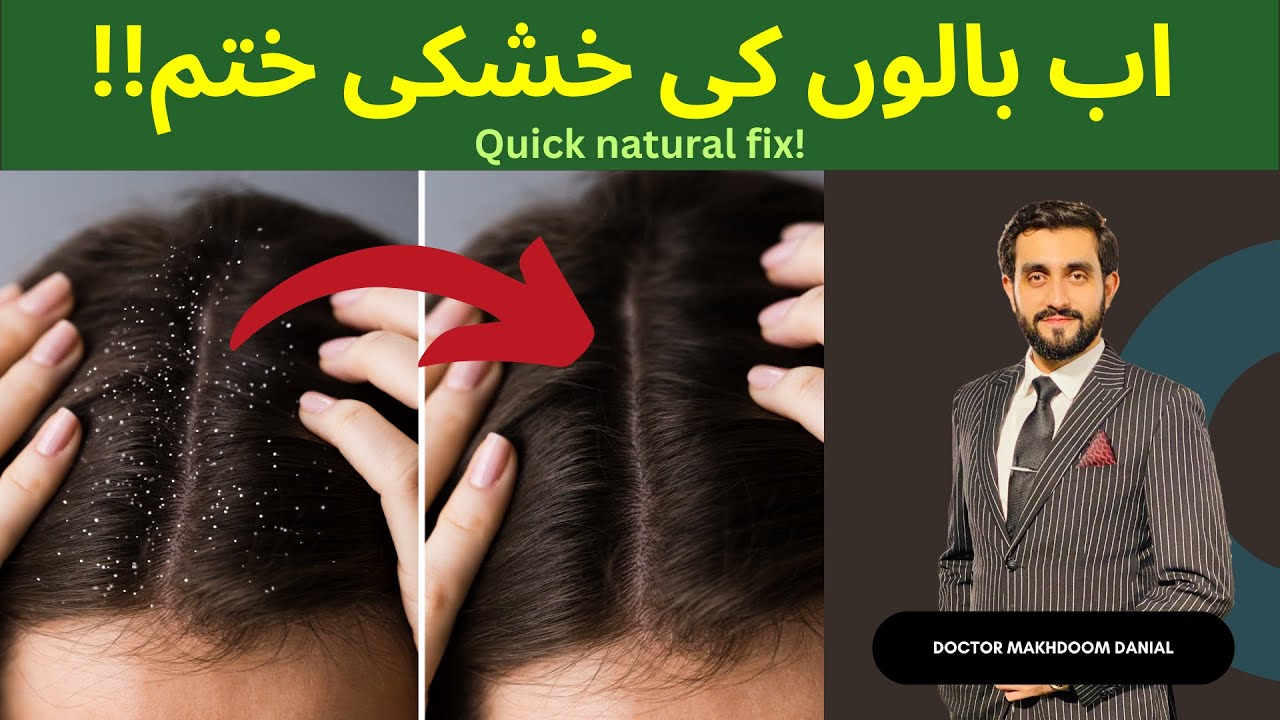 Real Cause & Treatment of Dandruff with 100% results in just 7 Days ...