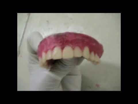 samiha 33 Festooning and sealing Upper trial denture - YouTube