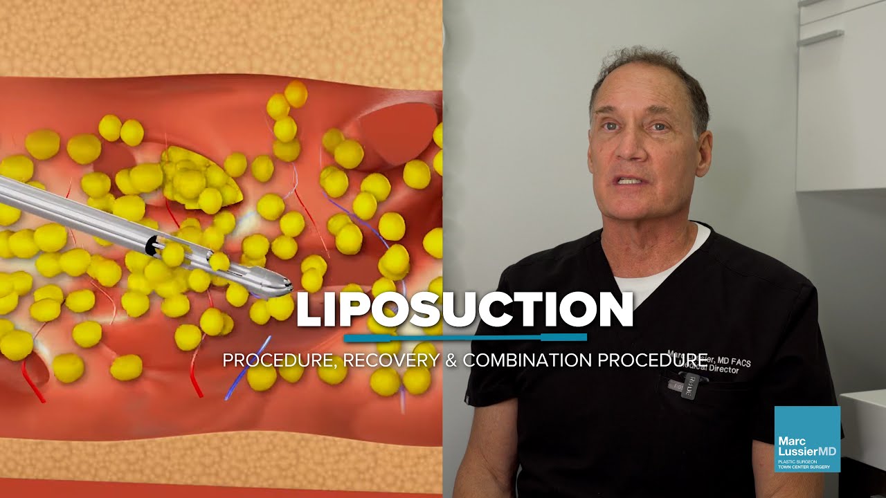 The Secret to Sculpting Your Dream Body: Liposuction + Morpheus8 ...