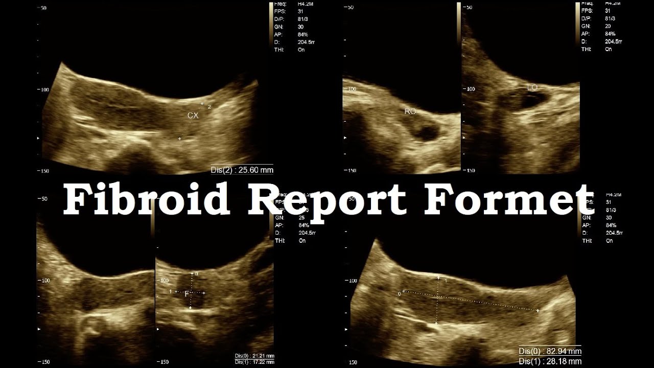 Fibroids in uterus ultrasound images | Fibroid uterus scan report ...