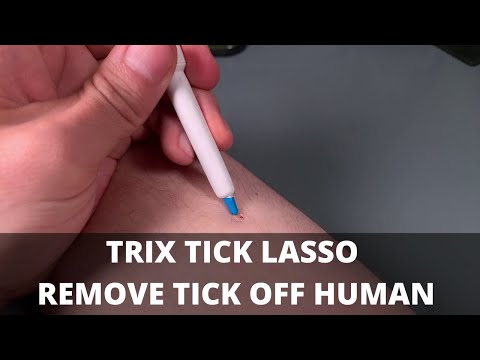 Trix Tick Lasso - Remove tick off human (me) - real use case