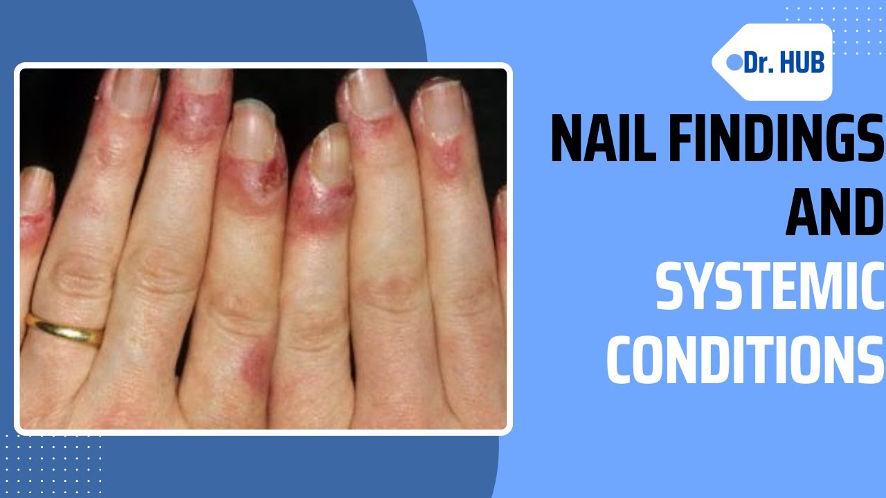 Nail Findings And Systemic Conditions - YouTube