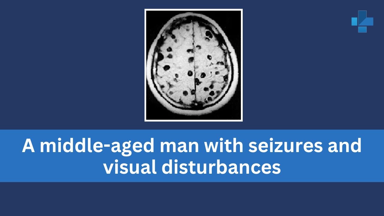 A middle-aged man with seizures and visual disturbances - YouTube