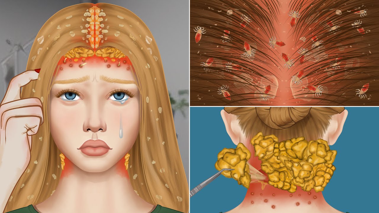 ASMR | Removing GIANT DANDRUFF hardened flakes, head LICE and ACNE from ...