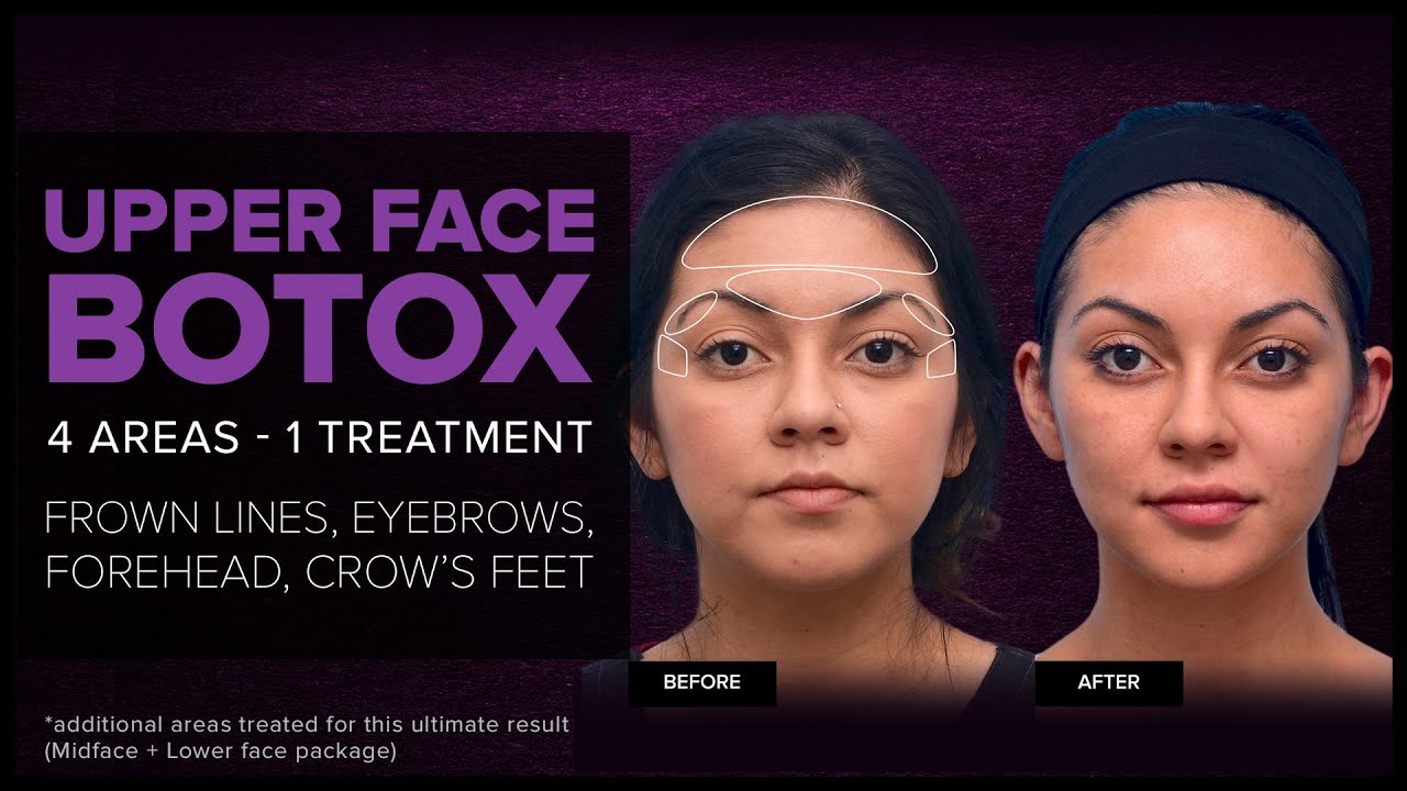 Upper Face Rejuvenation with BOTOX® at Mabrie Facial Institute - YouTube