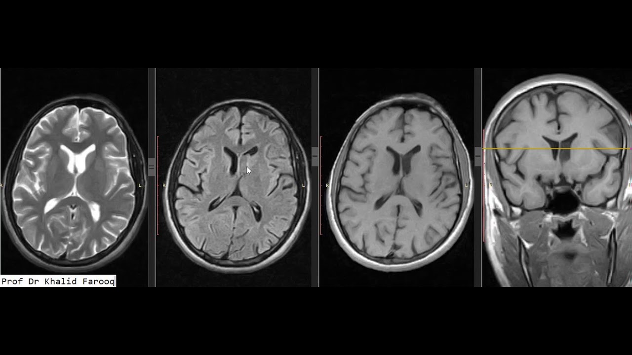 mri brain, intraventricular cyst with differential - YouTube