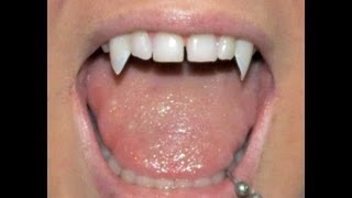 Vampire Teeth Implants