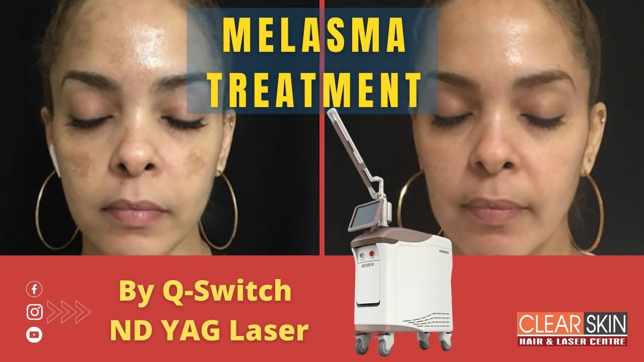 Melasma Treatment by Q Switch Nd || Laser Melasma treatment | Clear ...