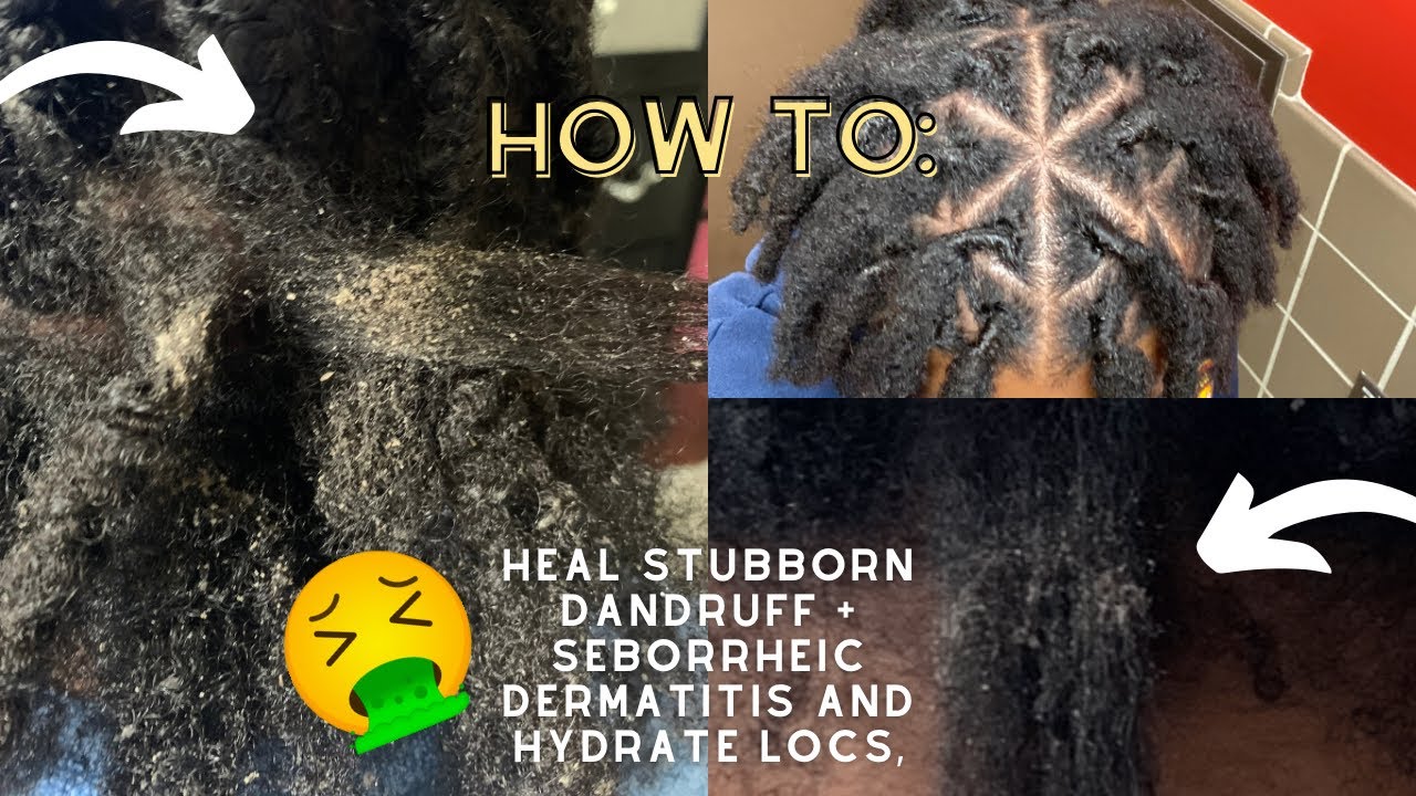 Heal Stubborn Dandruff🤮+ Seborrheic Dermatitis🤮 and Hydrate Locs ||DIY ...