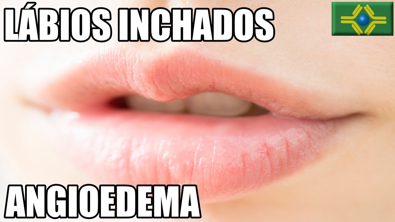 LÁBIOS INCHADOS | ANGIOEDEMA HEREDITÁRIO | Quais exames fazer? - YouTube
