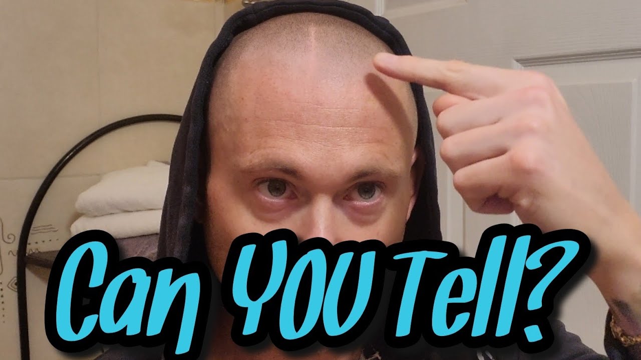 How real does scalp micropigmentation look? - YouTube