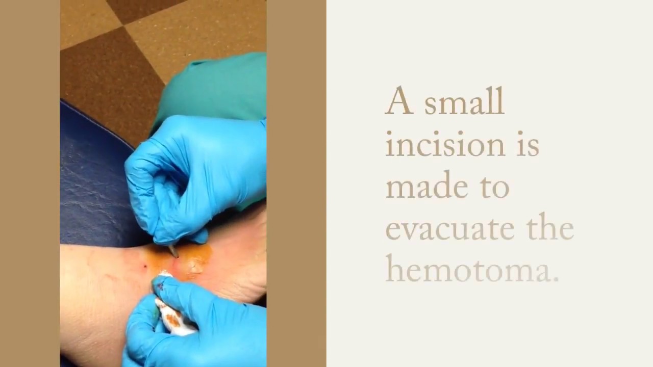 Draining a collection of blood from the foot - YouTube