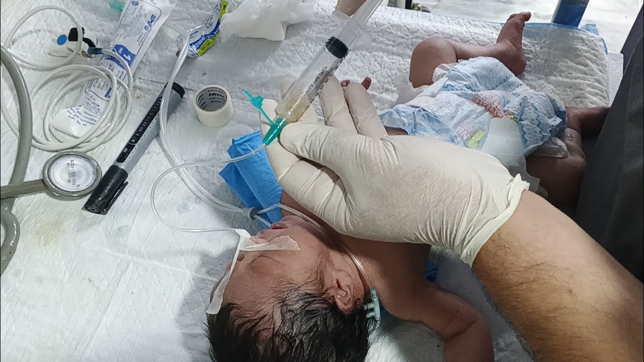 How to Pass an NG Tube to a Newborn Baby in the NICU | Step by Step ...