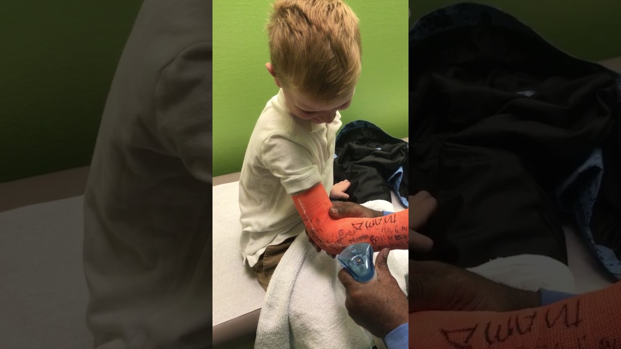 Cast removal - YouTube