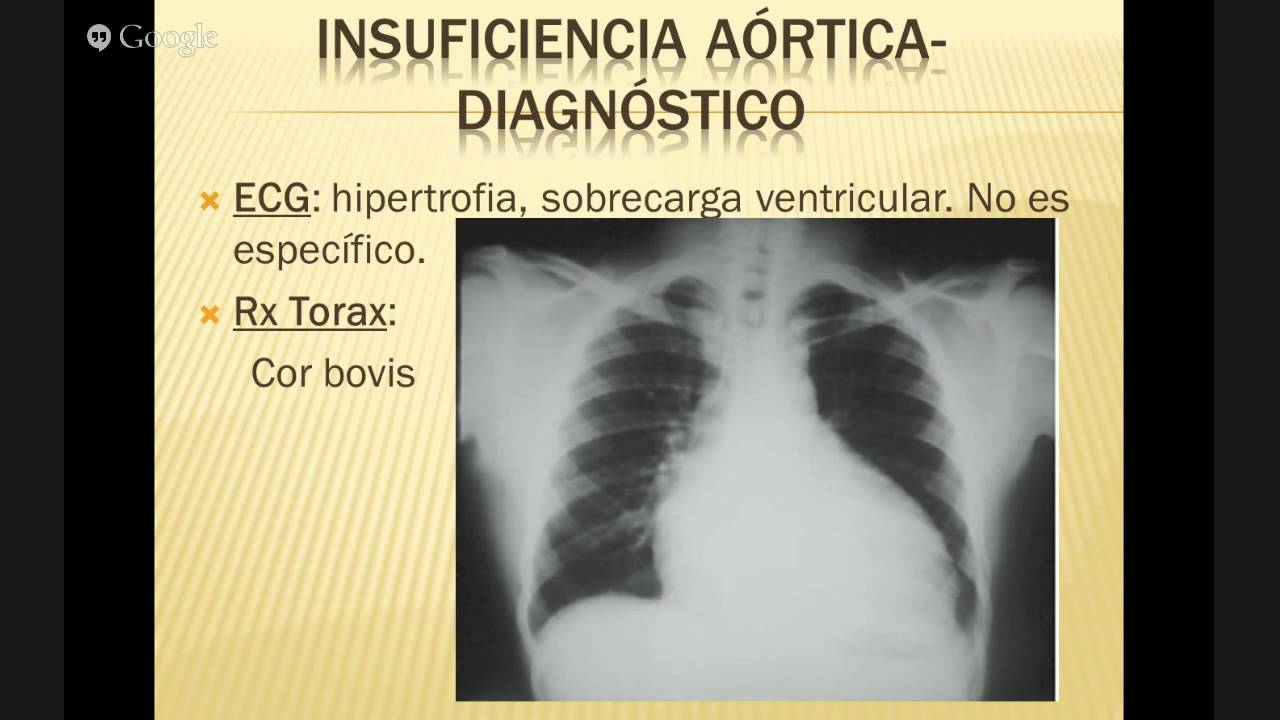 Radiografia De Estenose Aortica