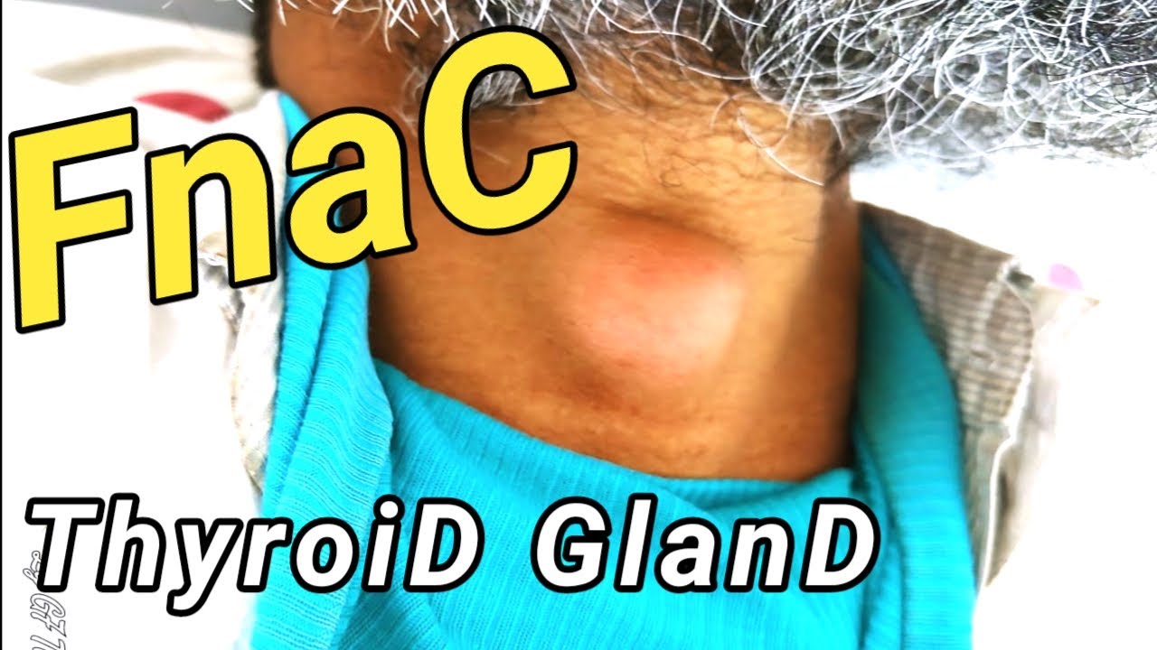 FNAC of Thyroid Gland।। - YouTube