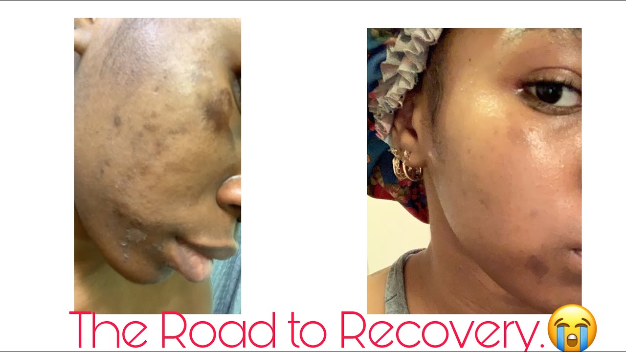 I Burned My Face!!|How I’m Clearing my Chemical Burns - YouTube