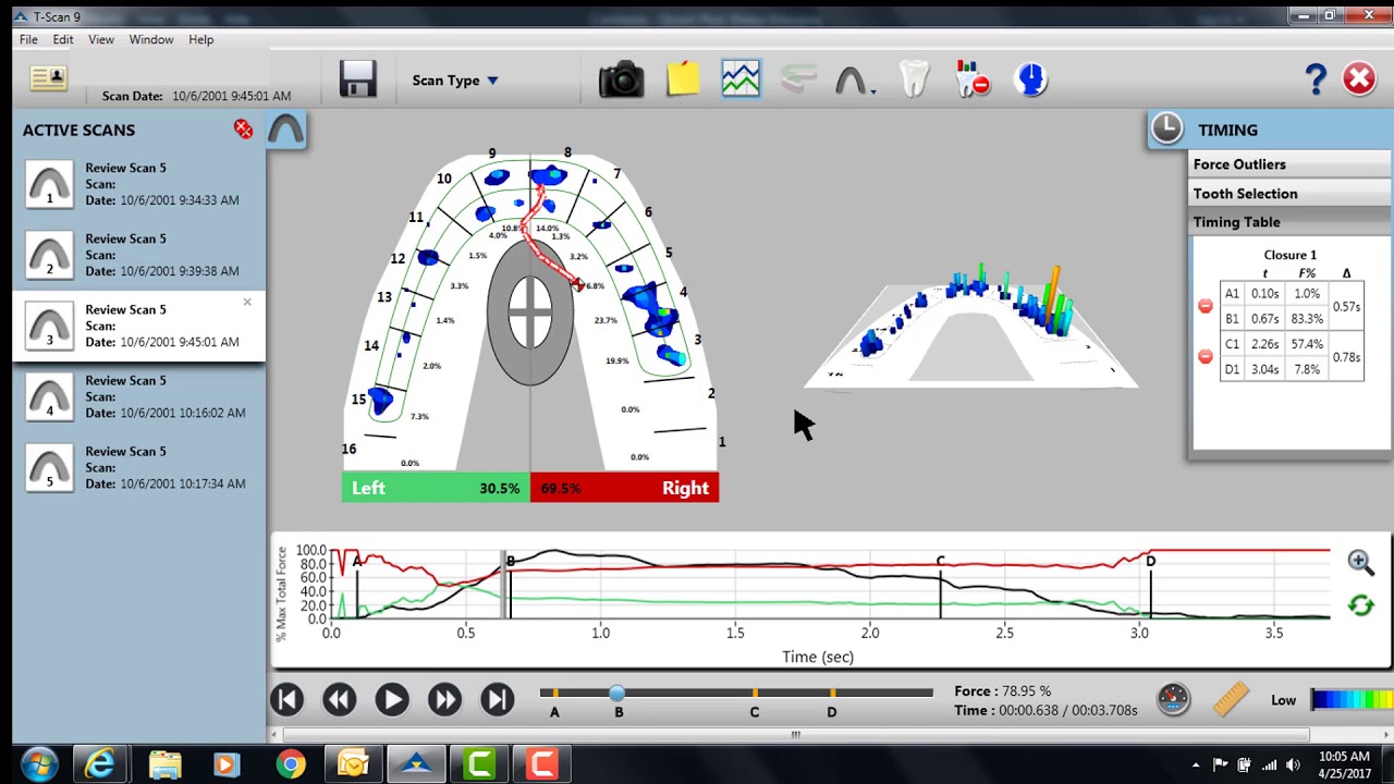 Five Scan Adjustment with T-Scan - YouTube