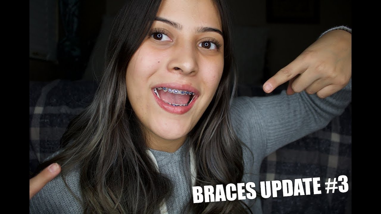BRACES UPDATE #3 - YouTube