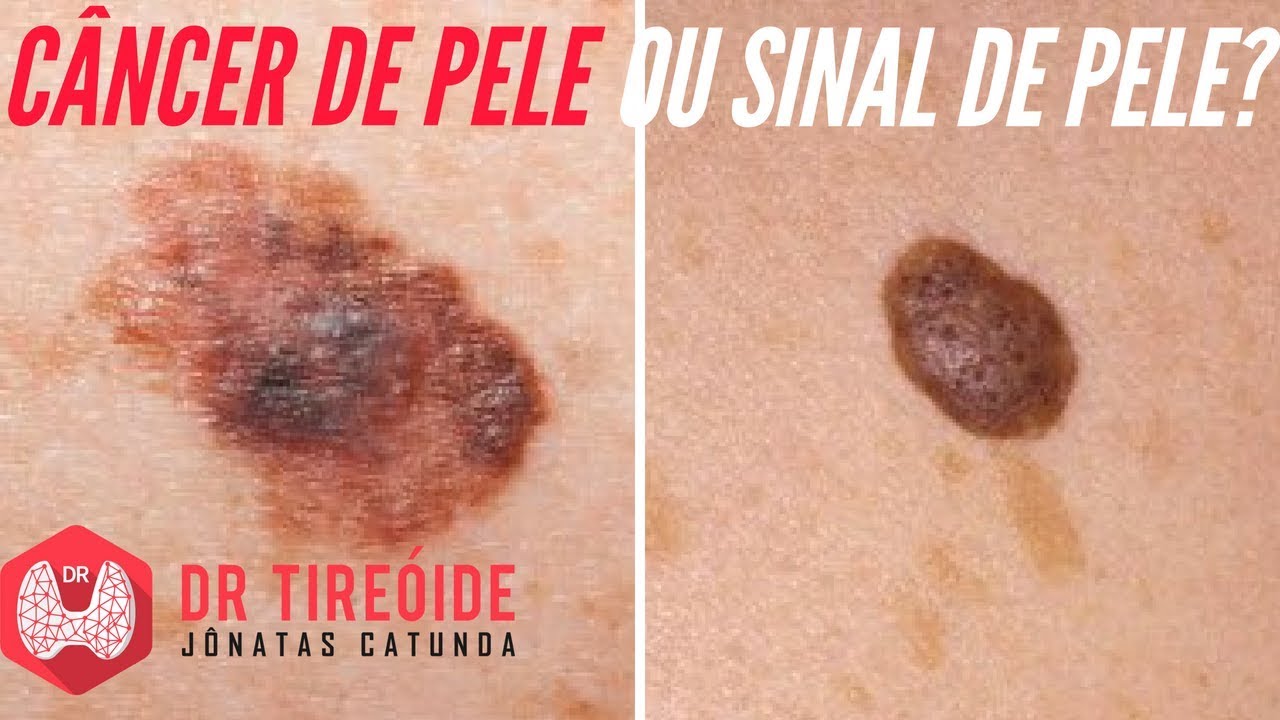 Sinais do Câncer de Pele - Melanoma X Sinal de pele | Dr Jônatas ...