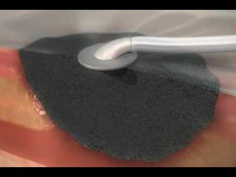 NPWT Therapy Mechanisms of Action Animation - YouTube